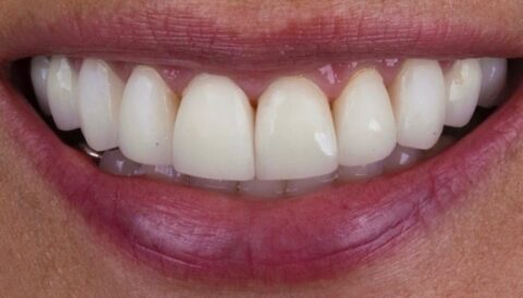 Carillas inyectadas de composite en Madrid - P&P Clinic