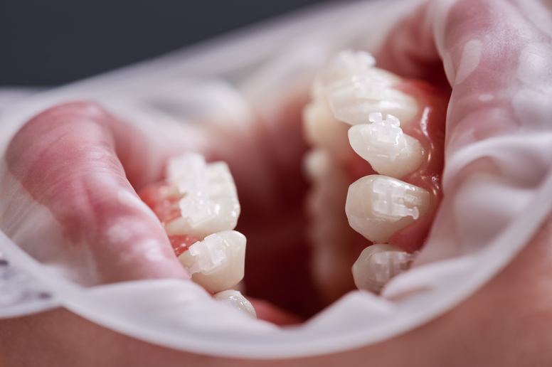 Ataches invisalign ¿qué son y para qué sirven? | P&P Clinic