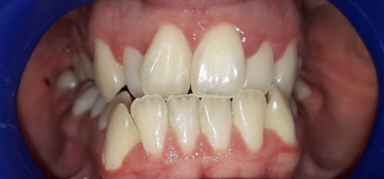 Invisalign Moderate | Precios, Antes y Después - P&P Clinic