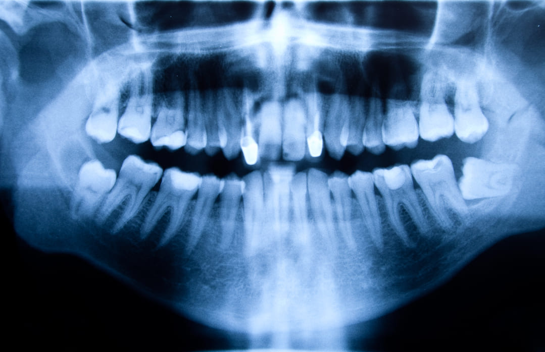 Descubre los mejores tratamientos de agenesia dental | Causas | Niños