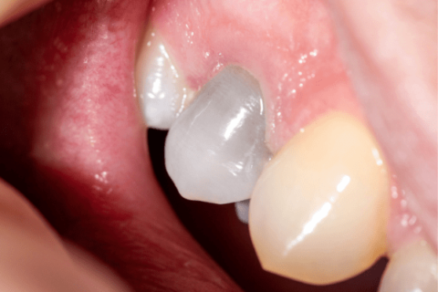 Tengo un diente gris: causas y tratamiento - P&P Clinic